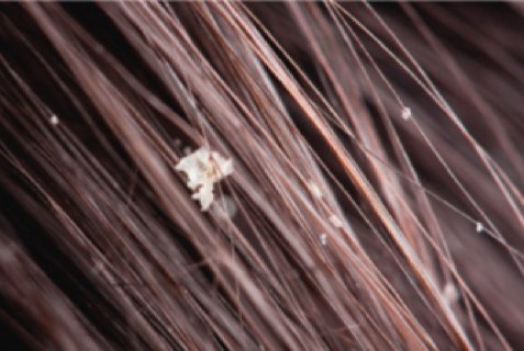 Dandruff | L'Oréal Dermatological Beauty