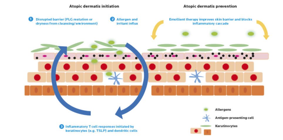Allergic sensitization, the role of the skin barrier