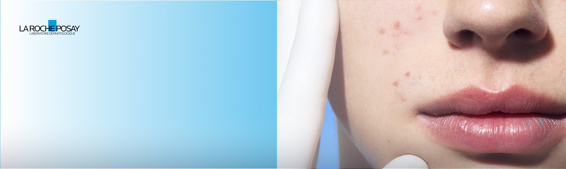 What are the different types of acne lesions? | LDB Pro