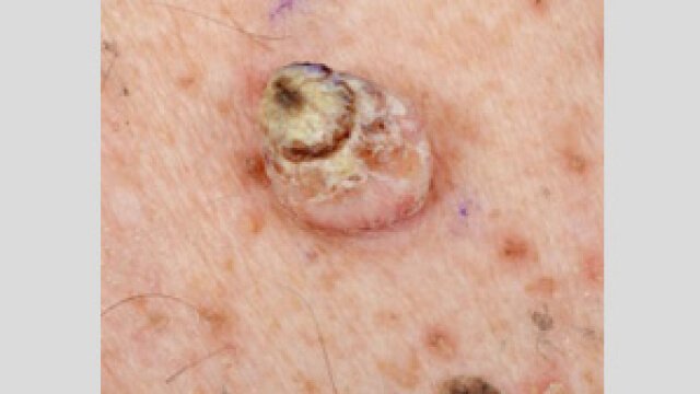 Keratoacanthoma | L'Oréal Dermatological Beauty